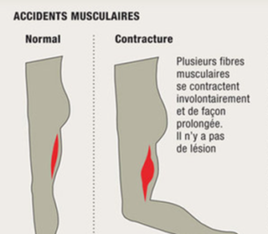 Les contractures musculaires à Annecy - Cryothérapie