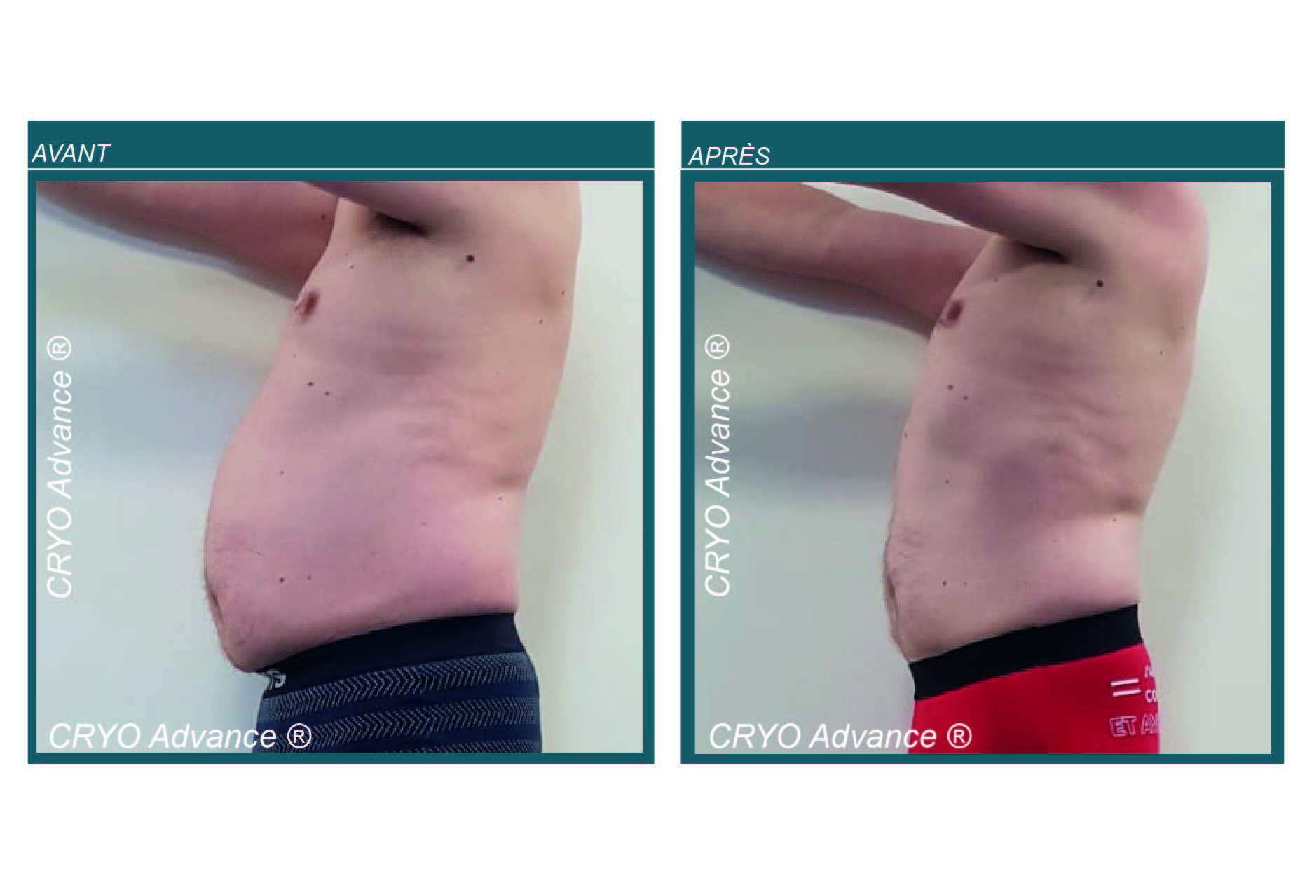 Cryolipolyse Cristal Pro à Annecy - Centre CryoAdvance